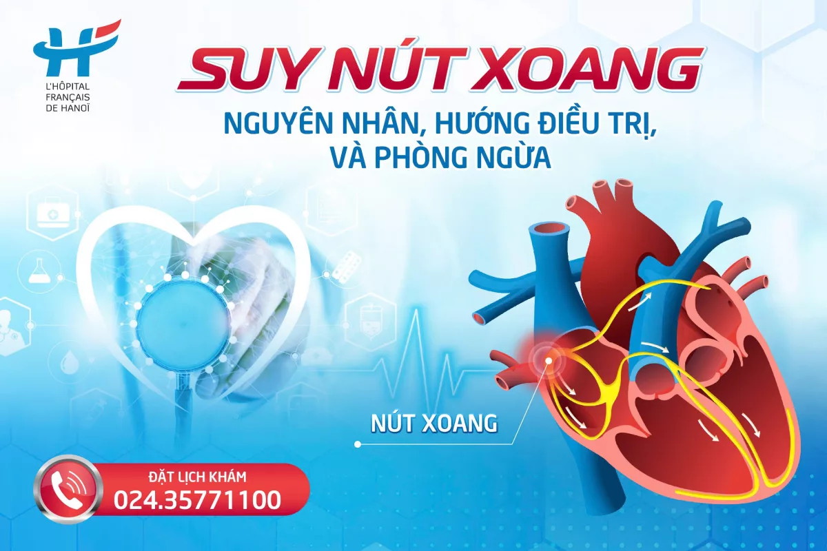 Suy nút xoang: Nguyên nhân, hướng điều trị và phòng ngừa - Bệnh Viện ...